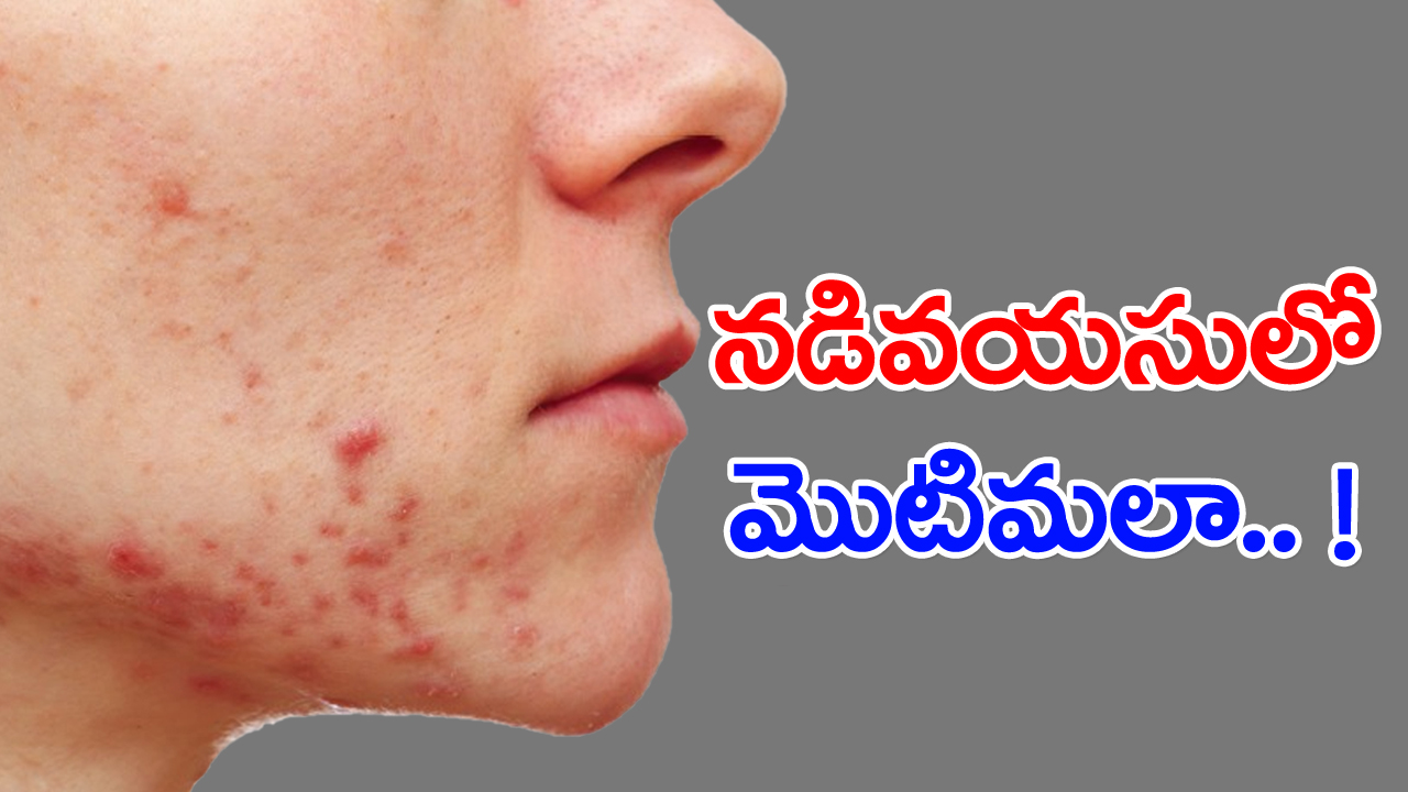 adult acne: నడివయసులో మొటిమల సమస్యా..! ఇవి తీసుకోండి. | acne problem in ...