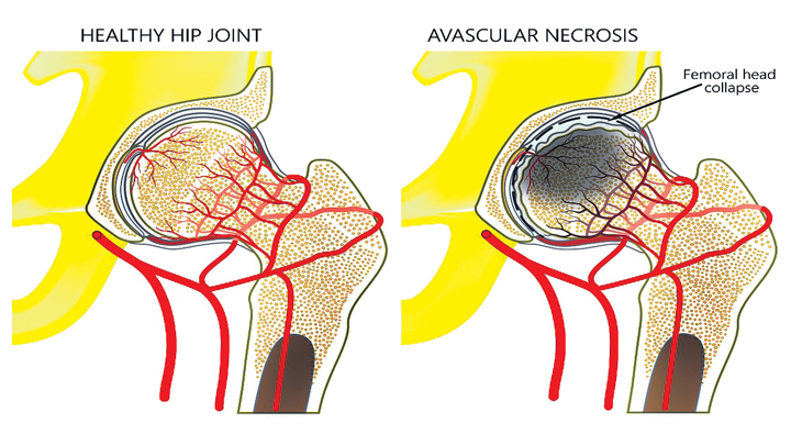యువతను వేధిస్తున్న ఎవాస్కులర్‌ నెక్రోసిస్‌ | Avascular necrosis ...
