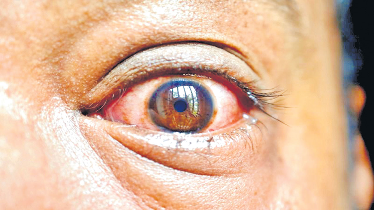 కలవరపెడుతున్న కండ్ల కలక Disturbing eye twitching కలవరపెడుతున్న కండ్ల ...