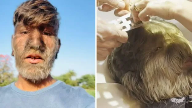 World Record for hairiest face: అరుదైన వ్యాధి ఉన్న మధ్యప్రదేశ్ ...