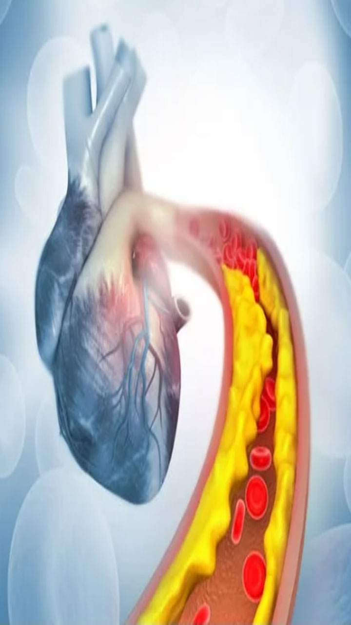 చెడు కొలస్ట్రాల్‌ను ఇలా కరిగించుకోండి..